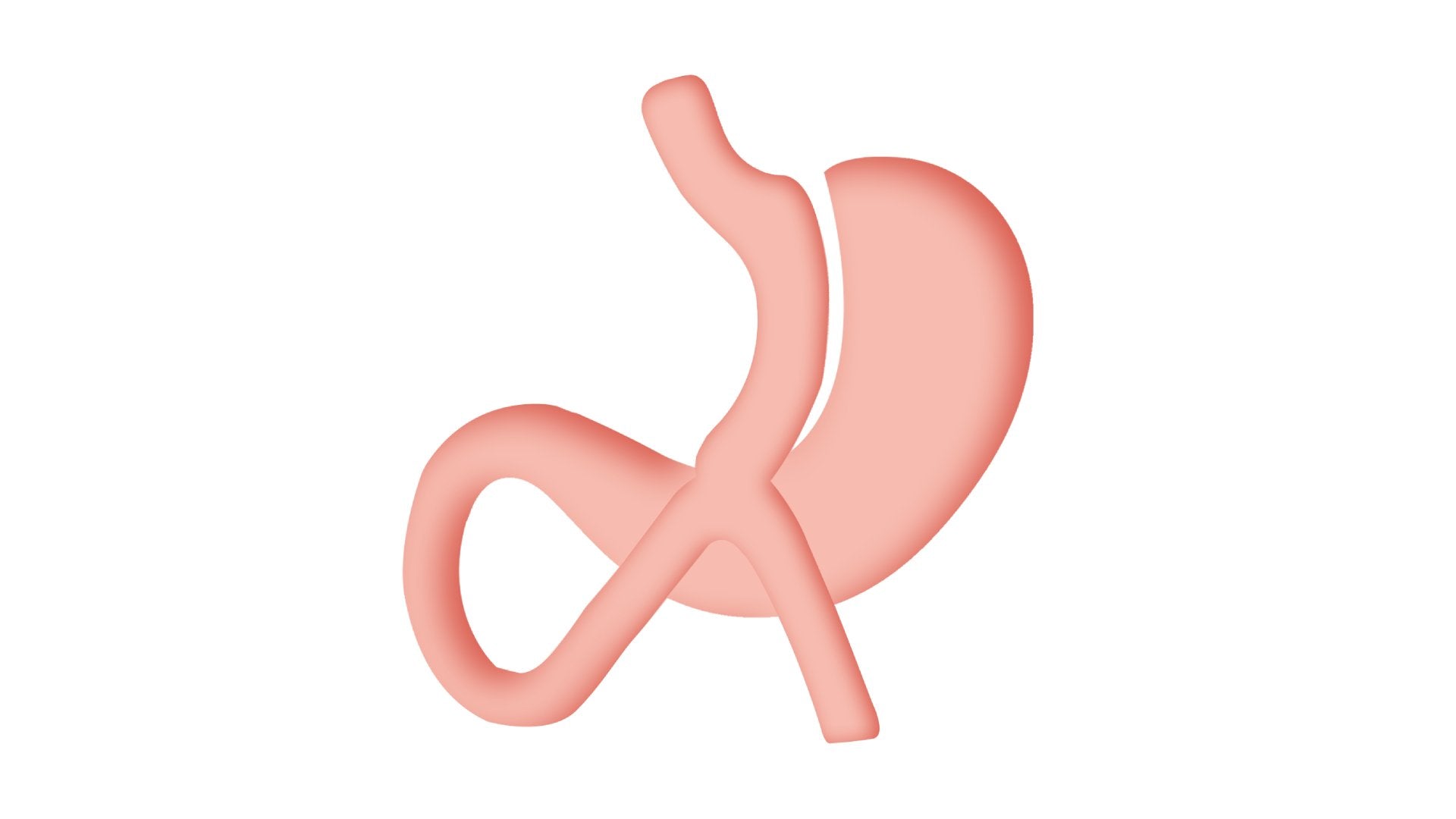 Mini Gastric Bypass - Procedure & Results Explained!